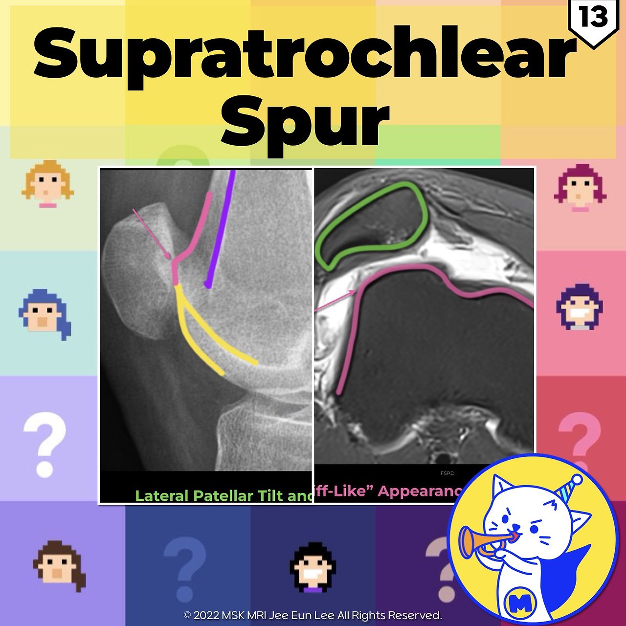 (Fig 4-A.13) Supratrochlear Spur in Trochlear Dysplasia