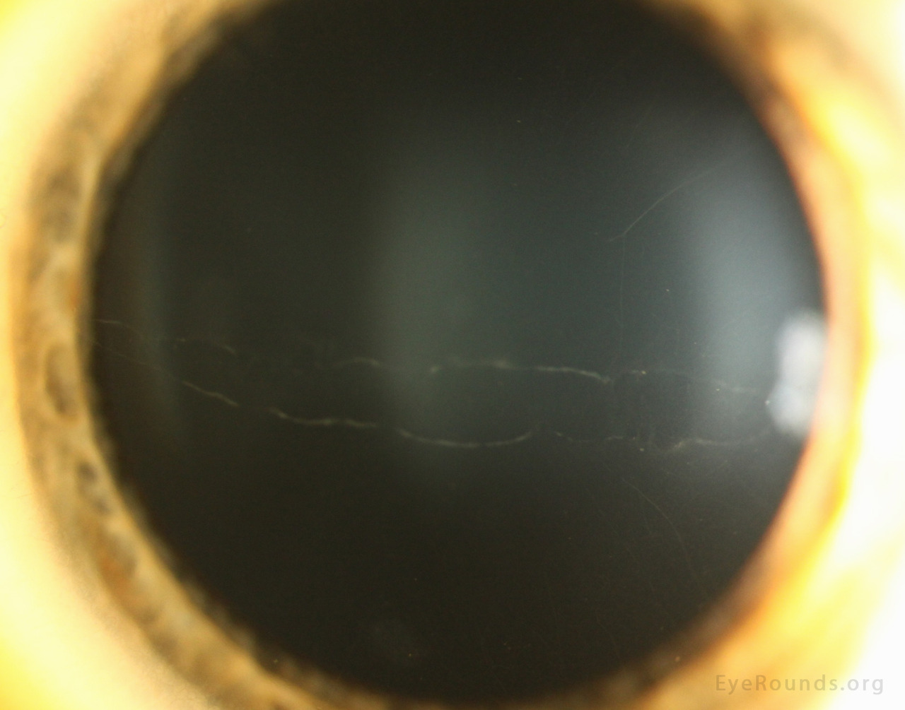 PPMD(Posterior Polymorphous Corneal Dystrophy, PPCD), 후부다형각막이상증의 원인, 치료 ...