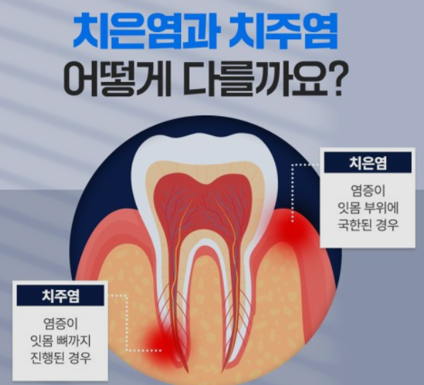 치주 질환 예방 치은염과 치주염의 원인과 증상 치료와 예방법
