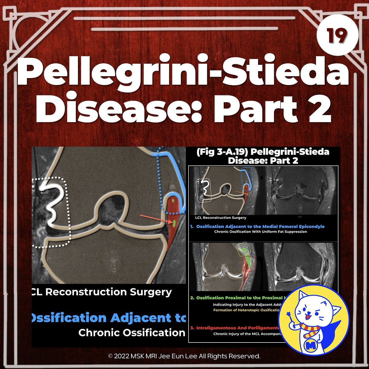 (Fig 3-A.19) Pellegrini-Stieda Disease_ Part 2