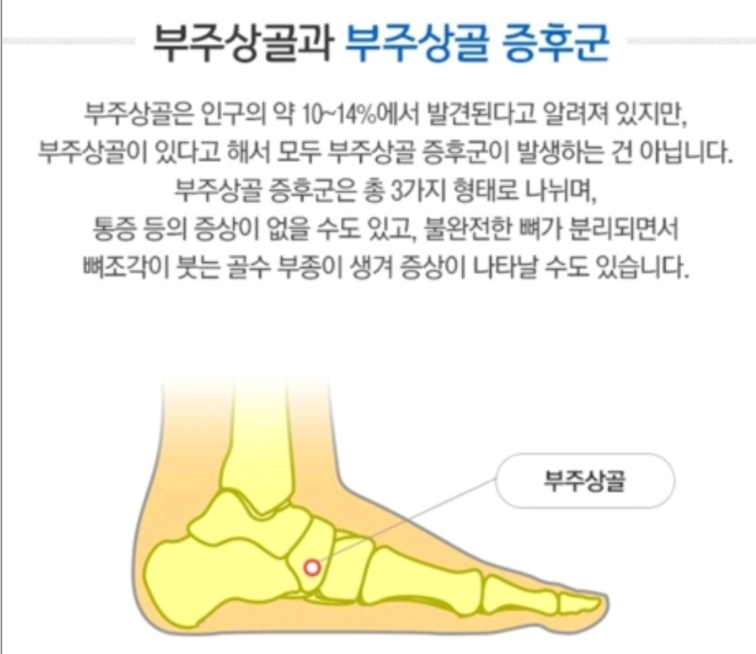 부주상골 증후군 아이 복숭아뼈 밑에 복숭아뼈가 또 있어요