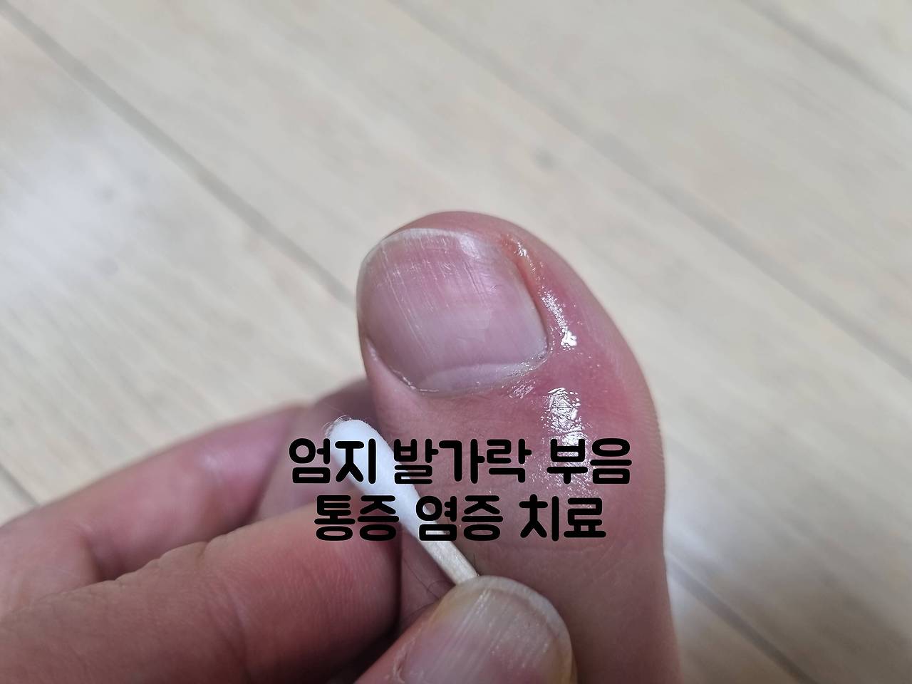 엄지발가락 부음 통증 염증 치료