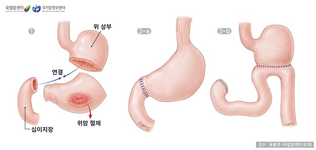 위암 기록하기 2 수술종류 및 방법 오늘의 스캘핑