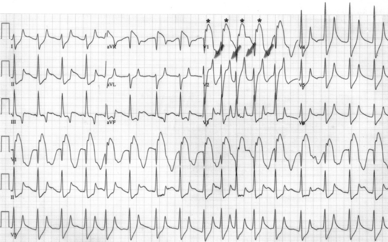 Hyperkalemia 고칼륨혈증 응급상황