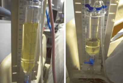 EVD(External Ventricular Drain) 간호, 관리