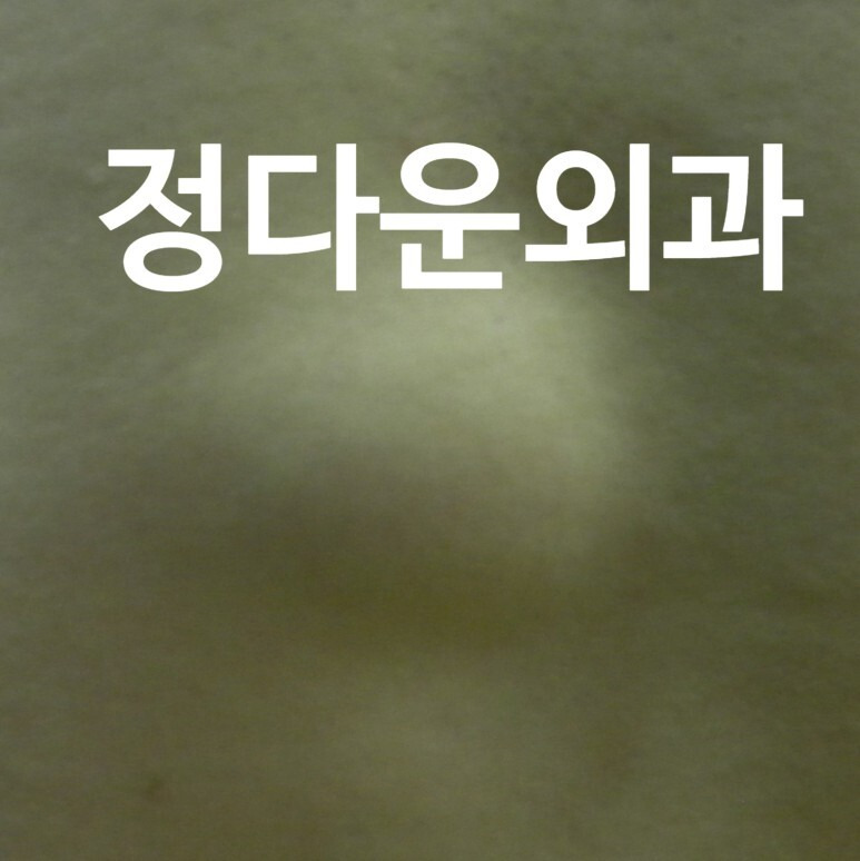 정다운 외과 별전 지방종 피지낭종 표피낭종 목에 혹이 난 것을 15년간 가지고 계셨다고 합니다