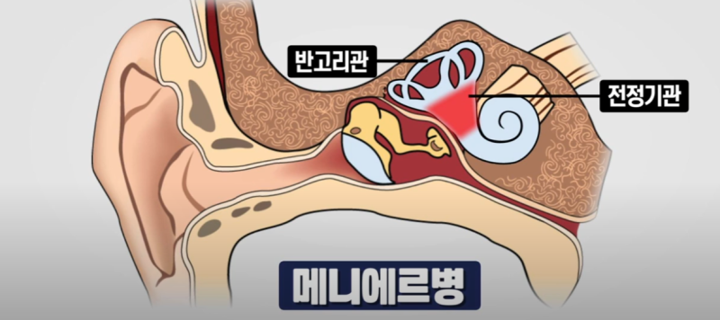 이석증 전정신경염 메니에르병의 차이점 회전성 어지럼증
