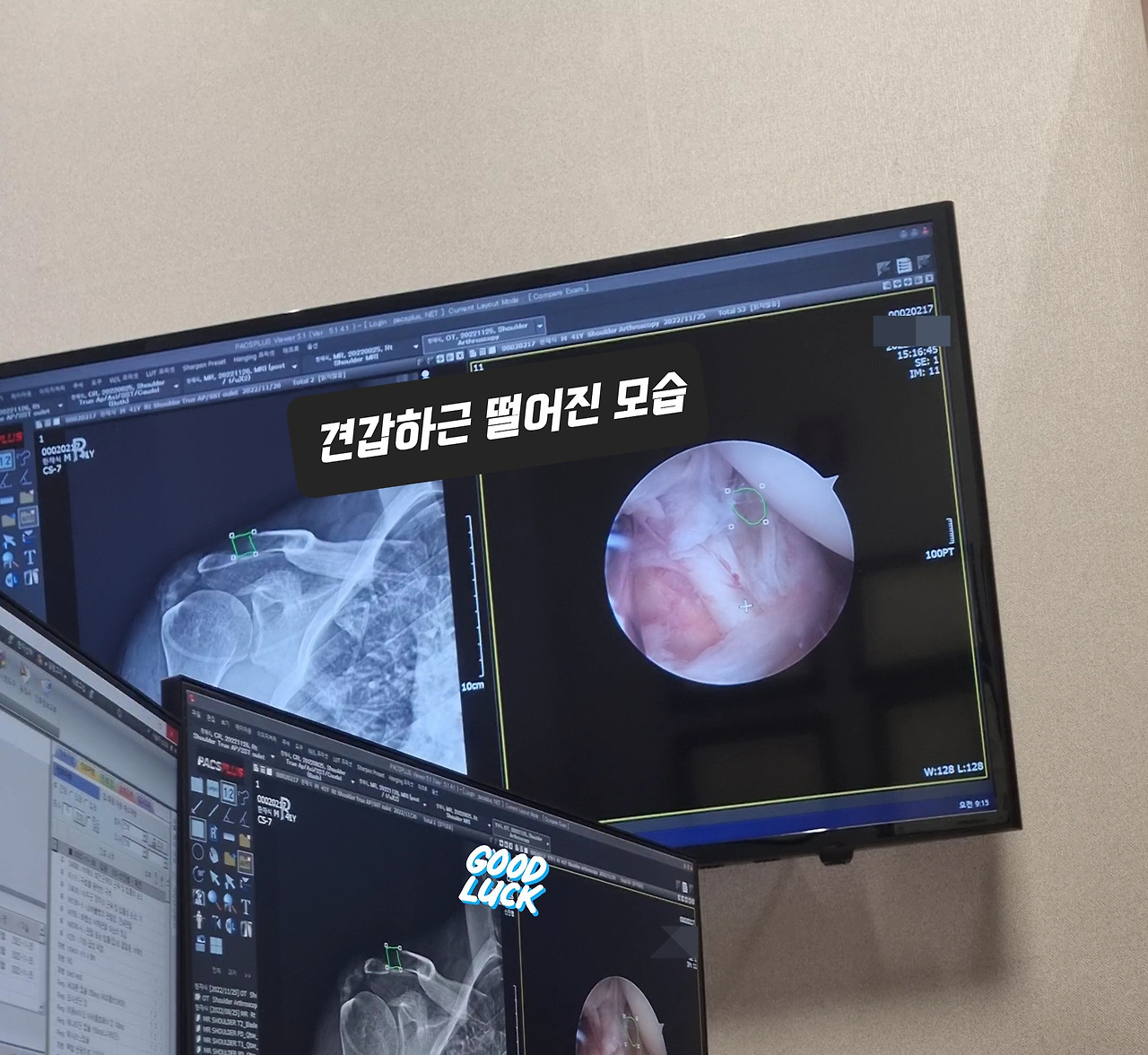 어깨수술 후 Mri 검사 결과 보기