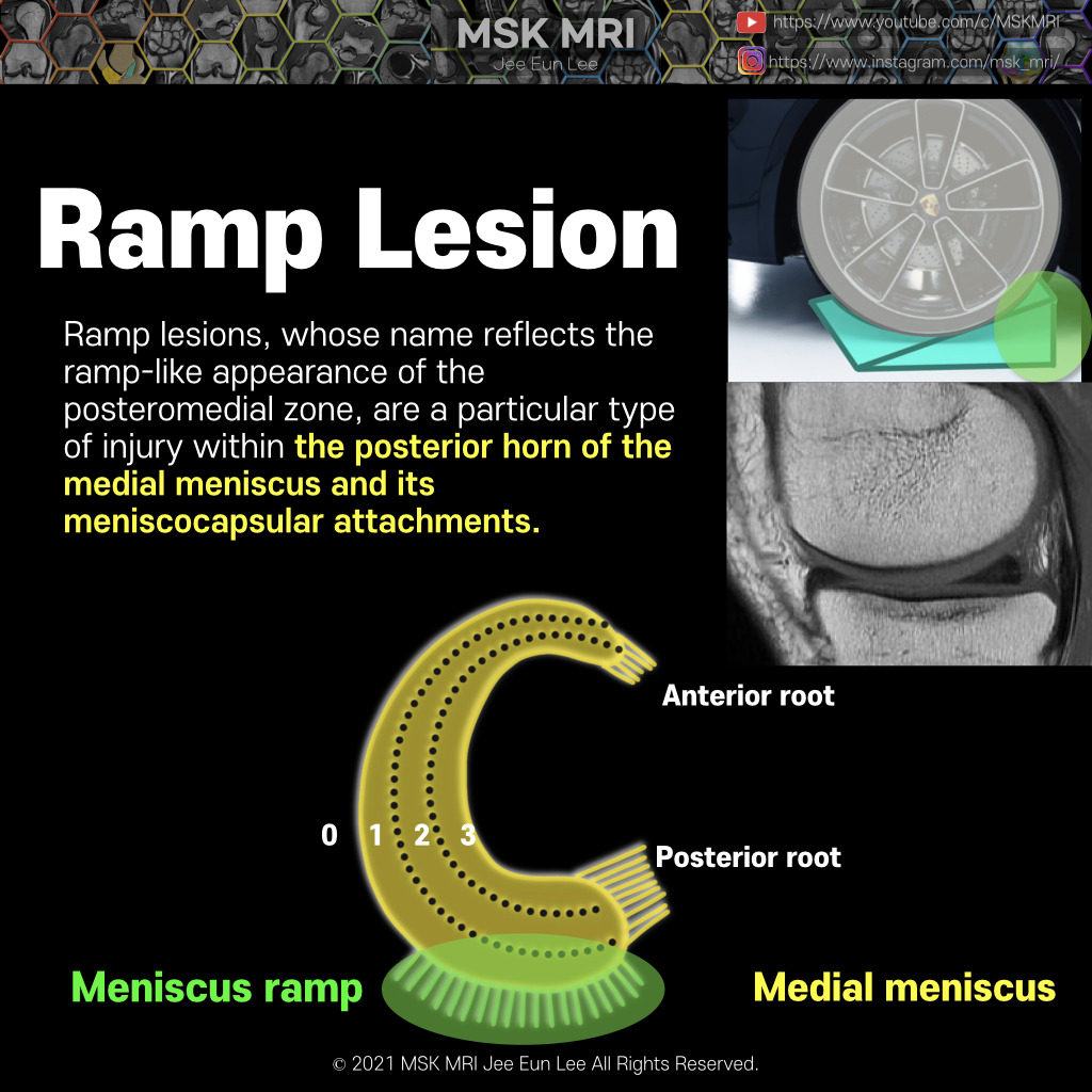 [Tear_15] Ramp lesion -01