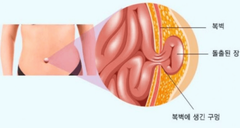 성인 소아 탈장의 증상 진단 치료