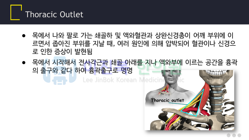 전주 이진복한의원 흉곽출구증후군