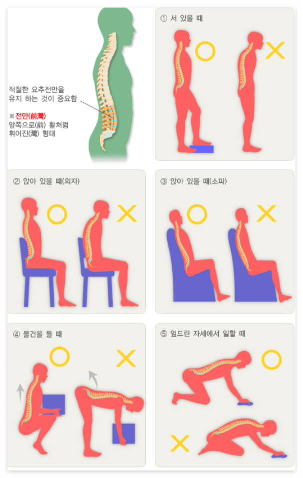허리디스크 터지면 좌골신경통 증상 알아보기
