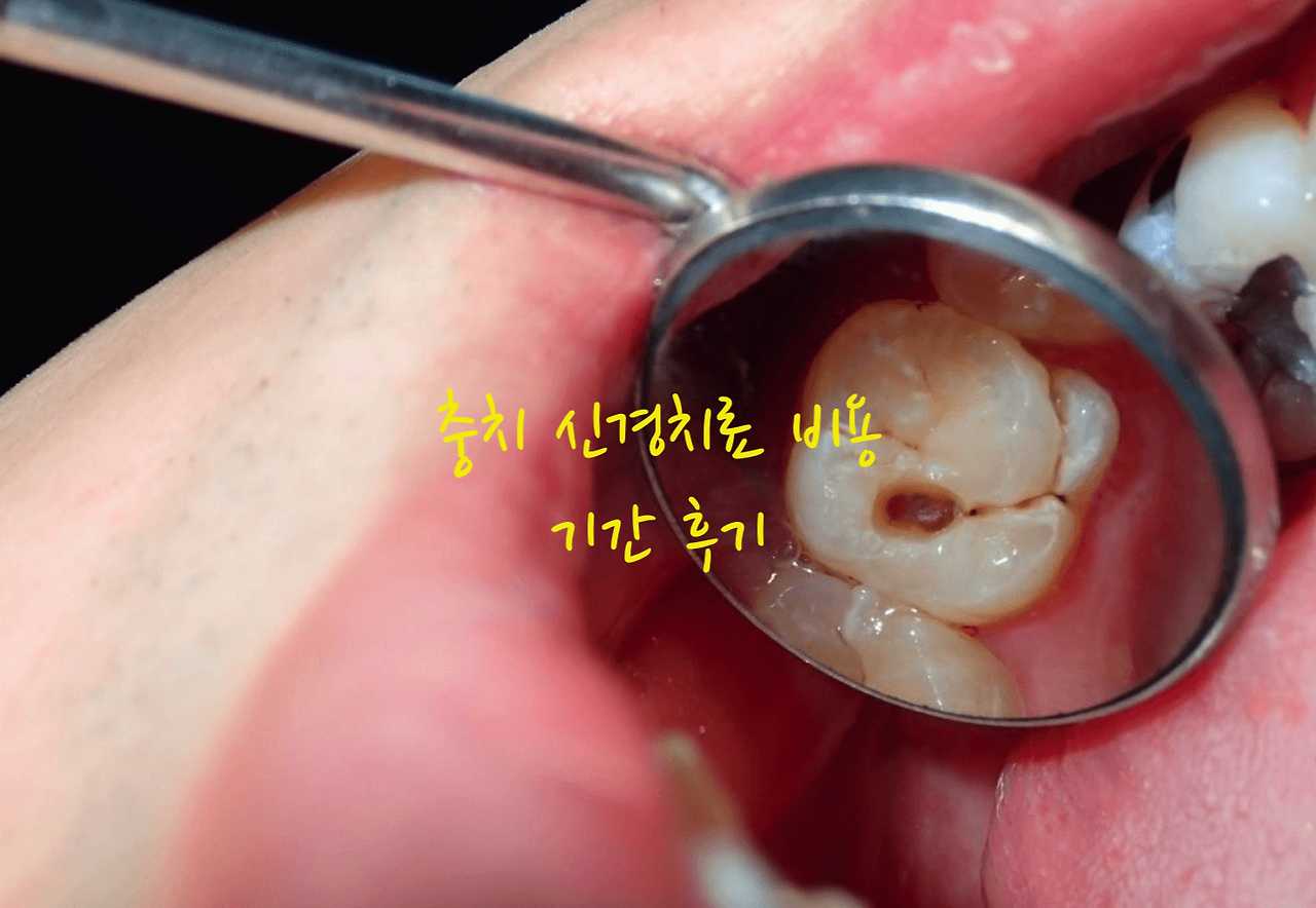 충치 신경치료 비용 기간 후기