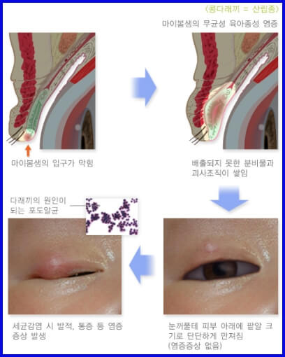 다래끼 빨리낫는 법 및 초기증상원인 증상 종류 전염 치료방법 경똑이