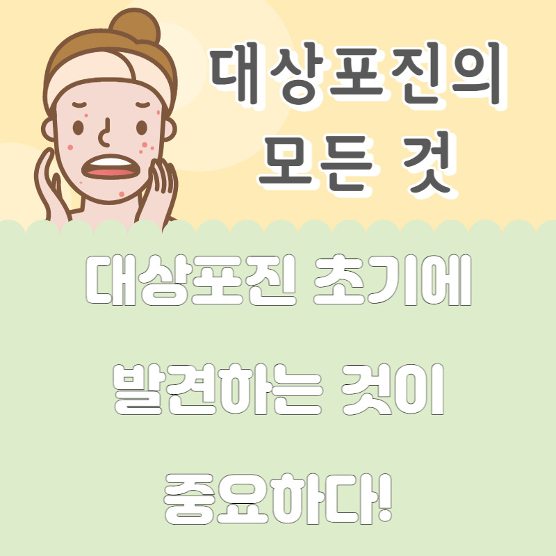 대상포진 초기증상 치료방법 빠를수록 좋은 이유