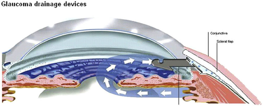 방수유출장치 Glaucoma Drainage Device / Implant, GDD, GDI 종류, Krupin, Ex ...