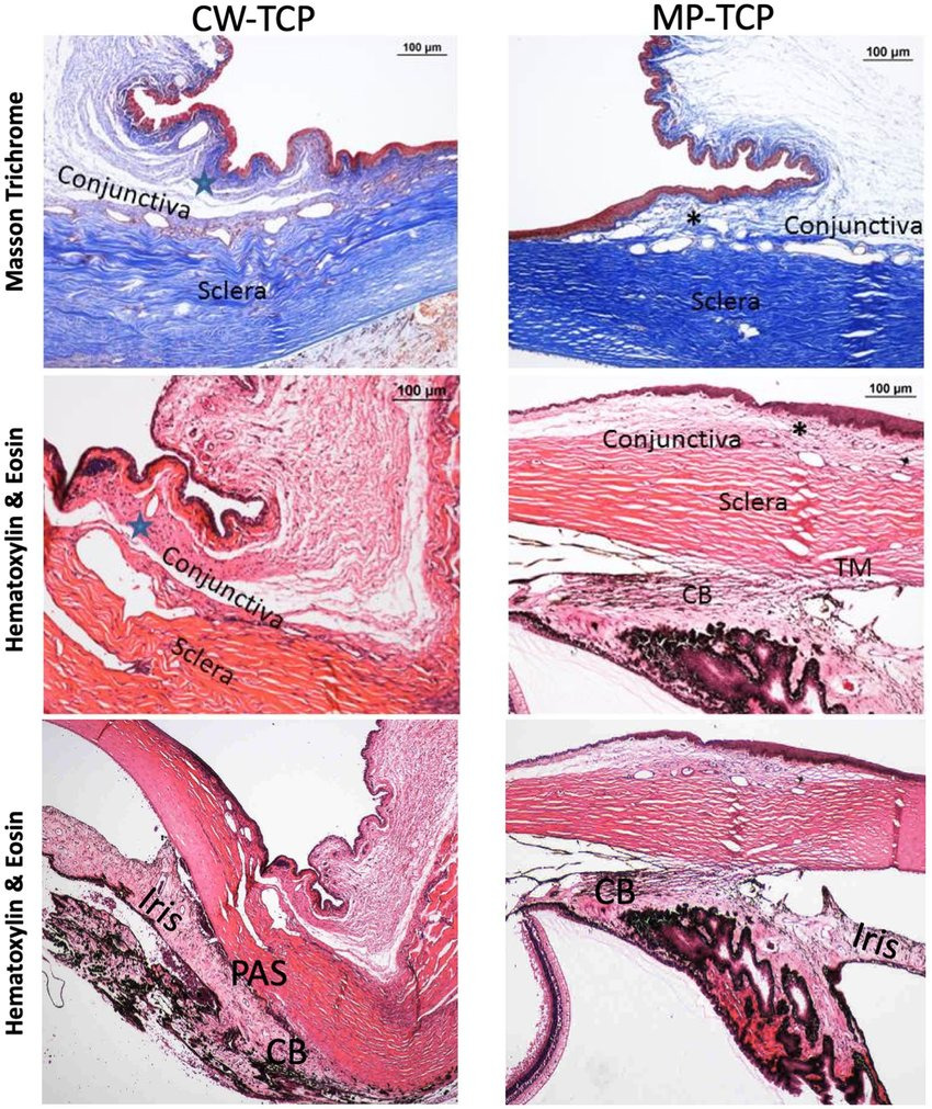 Diode Laser TransScleral CPC, 동공경유 광응고술, 눈속경유섬모체 광응고술