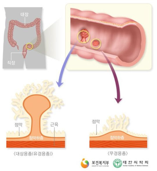 과형성 용종이란 증상 원인 치료 및 관리