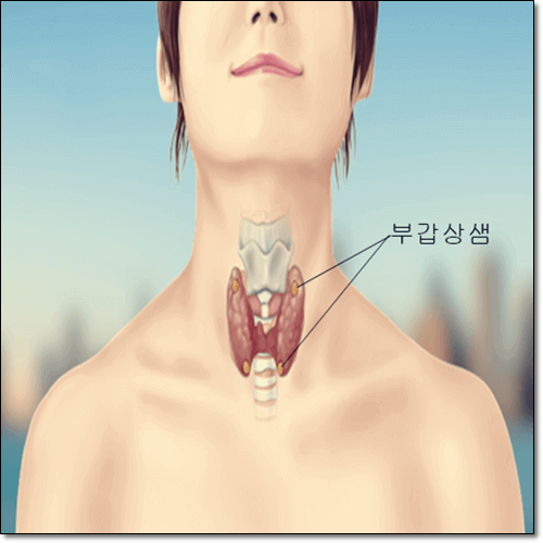 부갑상선기능항진증 증상 원인 및 치료 관리