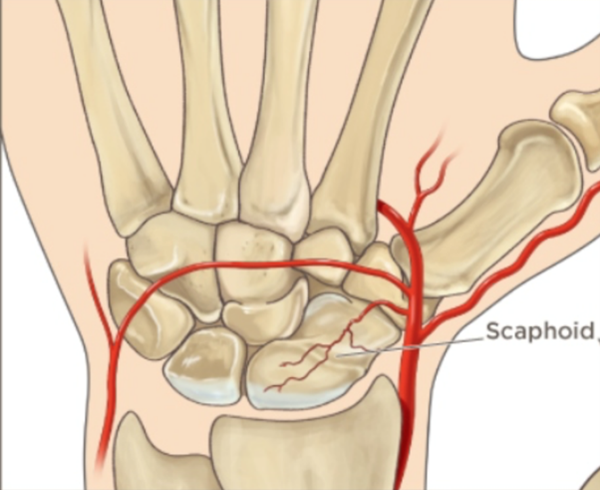 질병 손목뼈 주상골 골절scaphoid Fracture