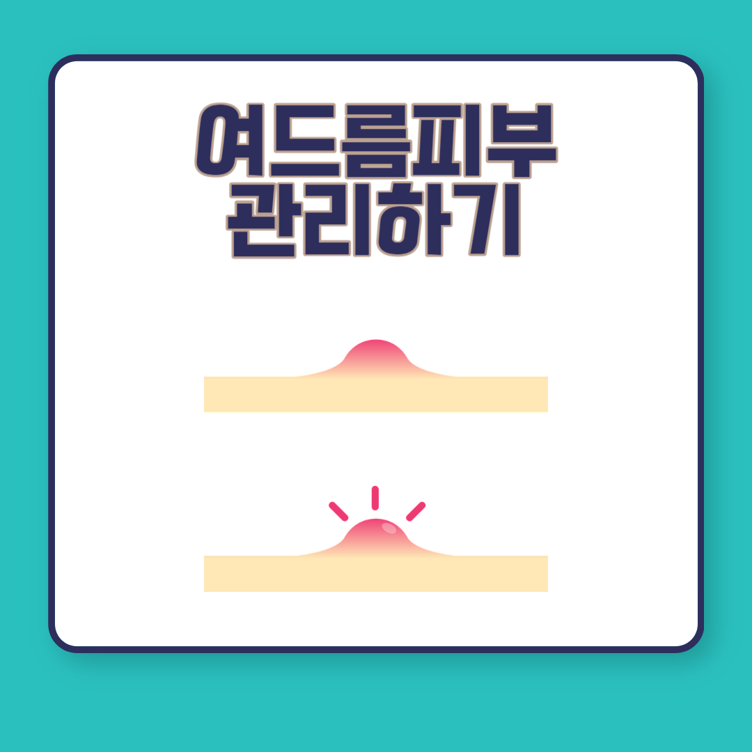 이소티논 로아큐탄 여드름약 후기 효능 효과 부작용 복용 주의사항 알아보기
