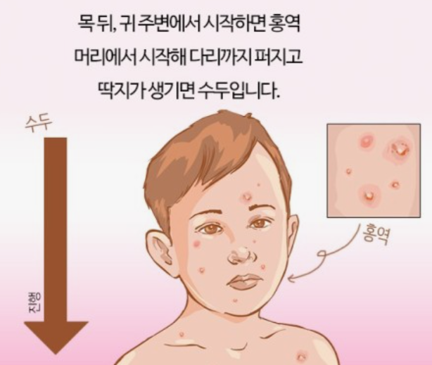 홍역 예방 접종 Mmr 백신 증상 병원 비용