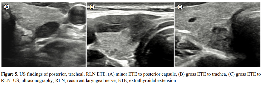 갑상선 결절 (2021 K-TIRADS)