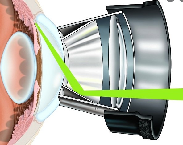 아르곤 레이저 섬유주 성형술(Argon Laser Trabeculoplasty, ALT) 원리, 기전, 치료방법