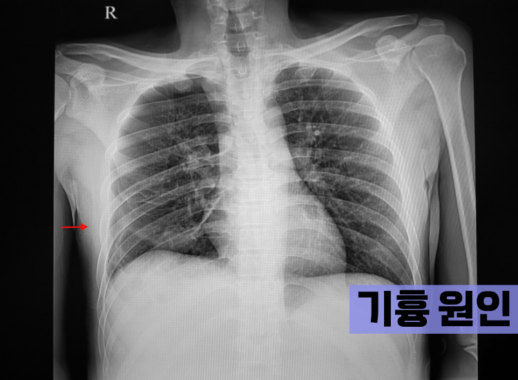 마른 체형은 더욱 조심해야 할 기흉 원인 증상 일차성 이차성 자발성 기흉