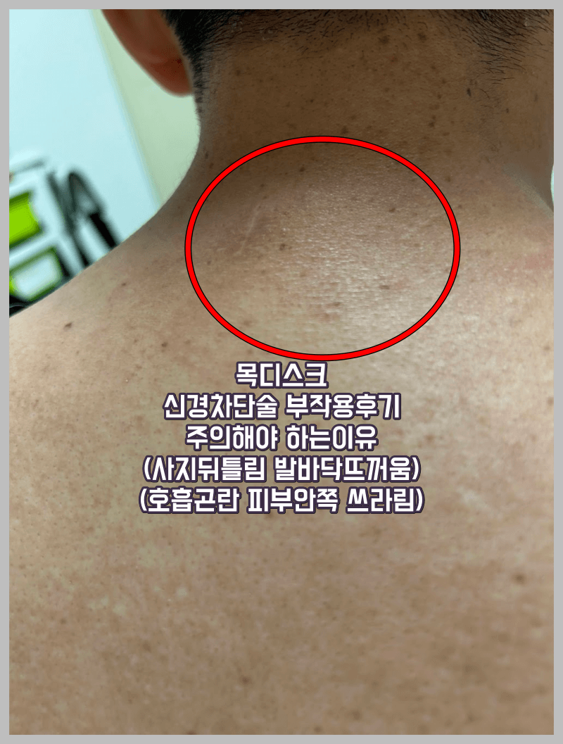 목디스크 신경차단술 후기 부작용 주의이유 도수치료비용 사지뒤틀림 발바닥뜨꺼움 호흡곤란 피부안쓰라림