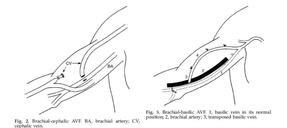 혈액투석 동정맥루 (AVF) 동정맥루수술 관련 정보
