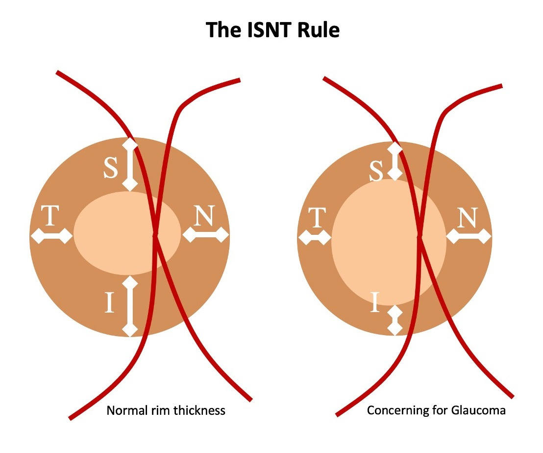 국소 망막신경섬유층 결손 RNFL defect 와 ISNT rule, IST rule