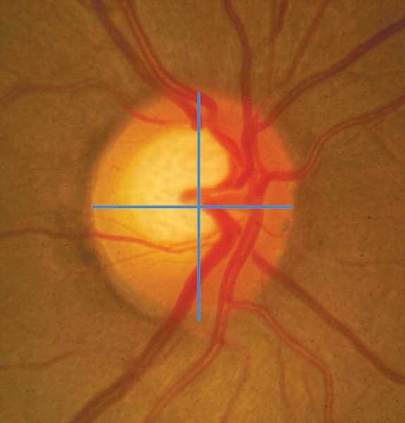 Temporal unfolding, Nasal cupping, Overpass cupping