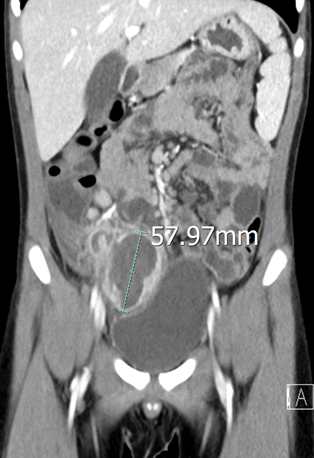 appendectomy(open)