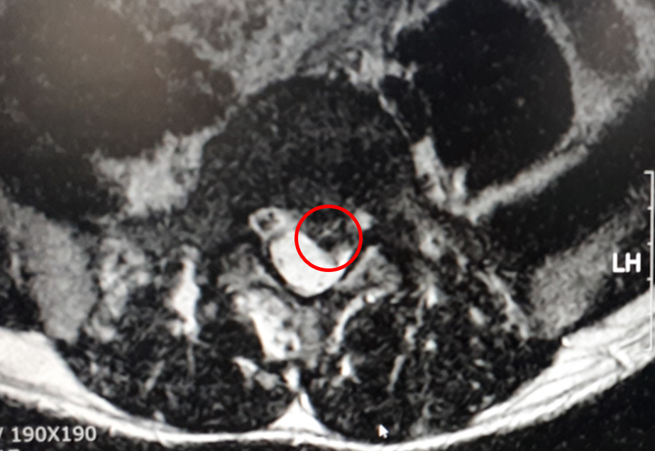 허리디스크 : MRI는 어떻게 볼까? :: 의대생의 의학 일기