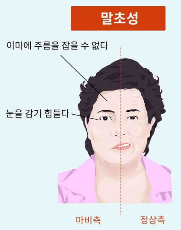 구안와사 전조 증상