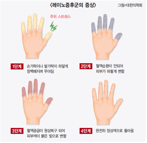 겨울철 손과 발 끝이 차가워지는 말초혈액순환장애 레이노증후군 동맥경화