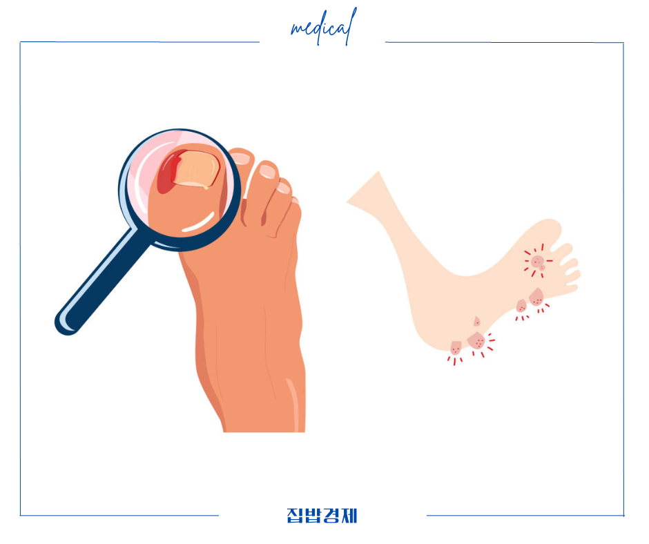 주블리아 외용액 손발톱무좀 효과 및 부작용과 가격 알아보기