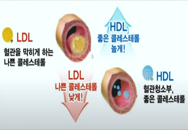 간강검진 이상지질혈증 콜레스테롤ldlhdl 중성지방 관리