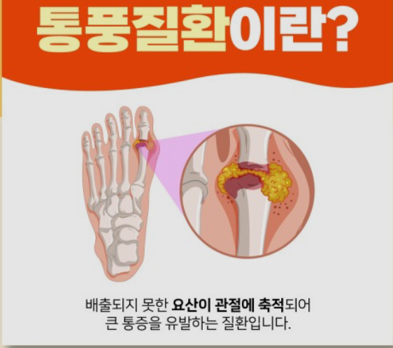 통풍의 증상과 예방 방법 건강 쉼표