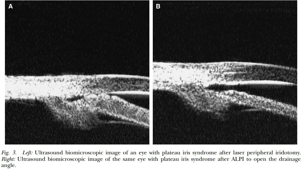 아르곤 레이저 주변홍채 성형술(Argon Laser Peripheral iridoplasty, ALPI, LPI, Argon ...