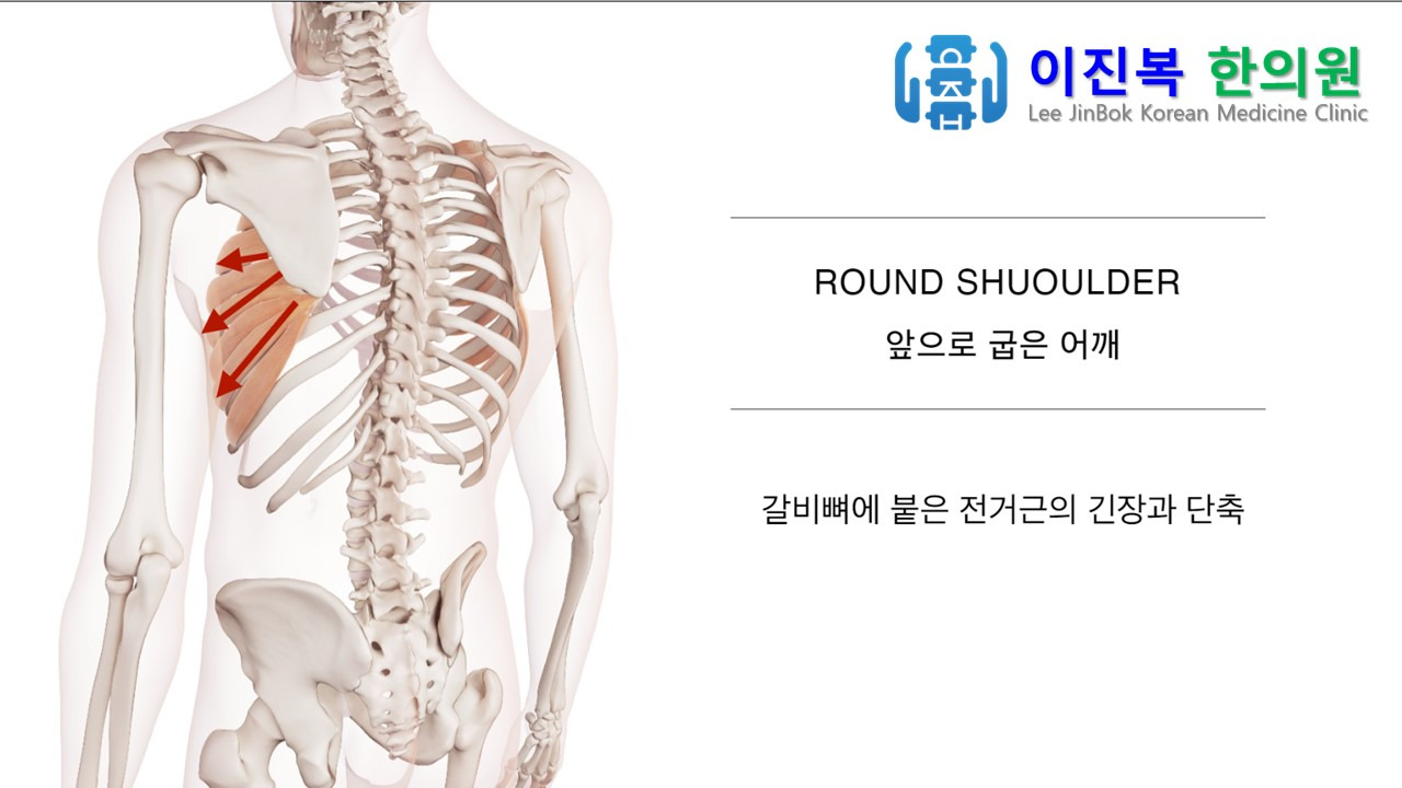 전주 이진복한의원 카이포시스 로도시스거북목 굽은허리