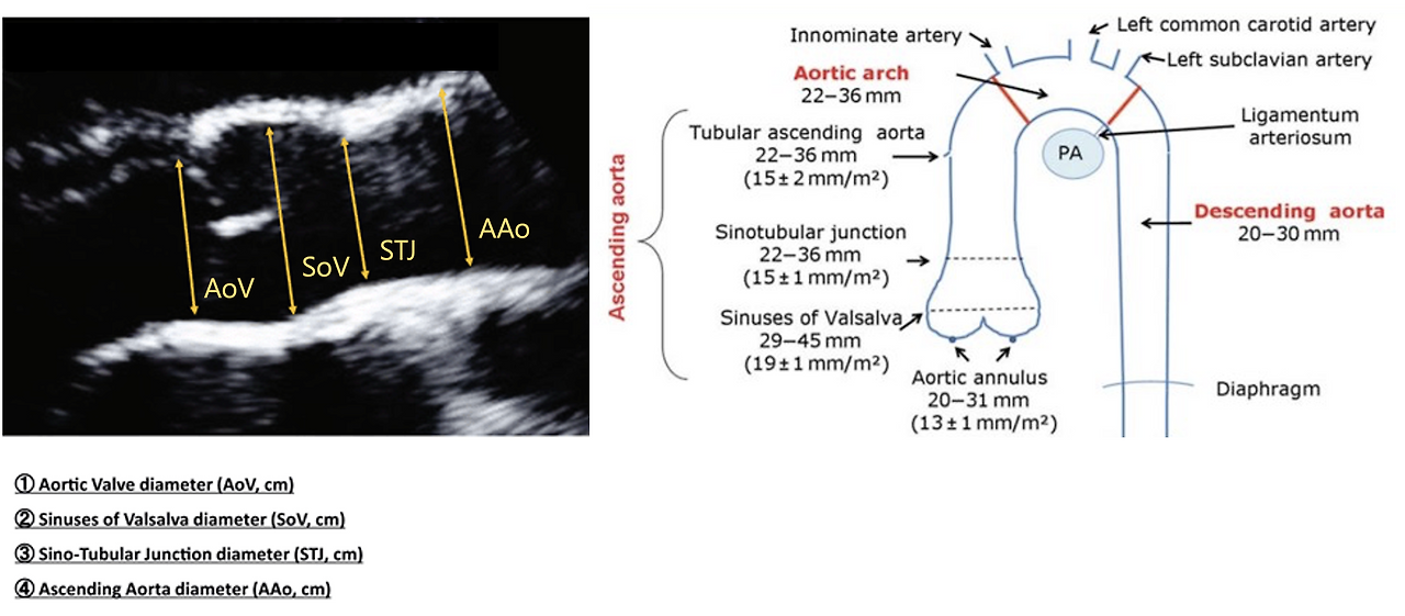 [심초음파] PLAX or PSLA (parasternal long axis view)