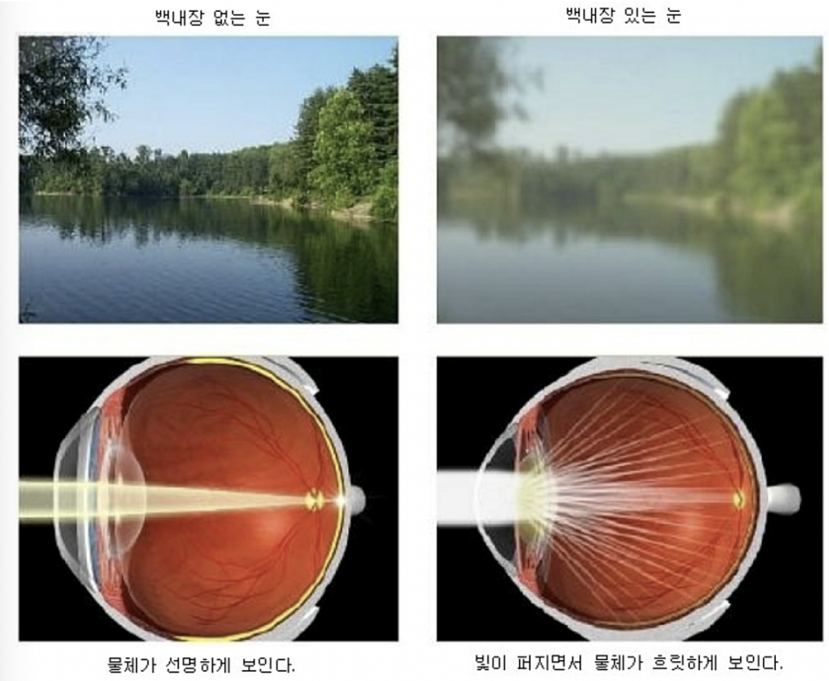 백내장 녹내장 증상 차이 자가진단 원인 총정리