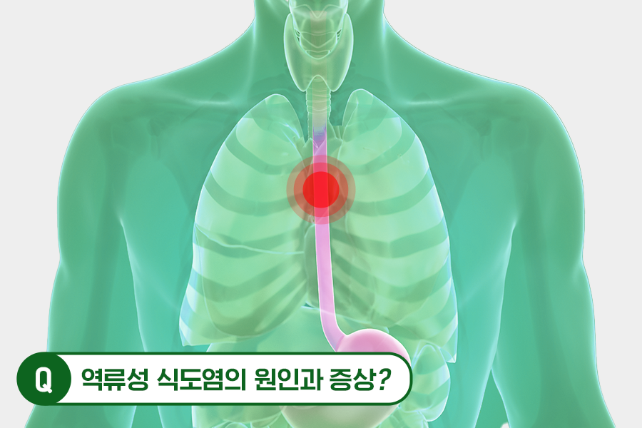 건강 Talk 현대인의 만성질병 ‘역류성 식도염 Vs 위염 증상과 예방법