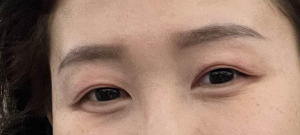 눈두덩이 알러지 눈꺼풀 빨갛게 부음 가려움 직접 해결한 방법 후기
