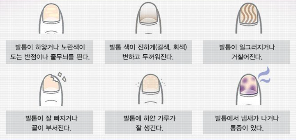 내 발톱에 무좀이 생겼어요 손발톱 무좀