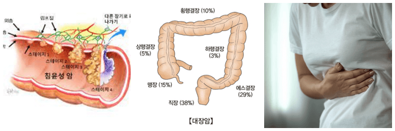 대장암 초기증상과 생존율 그리고 대장암 원인 검사 치료 예방법