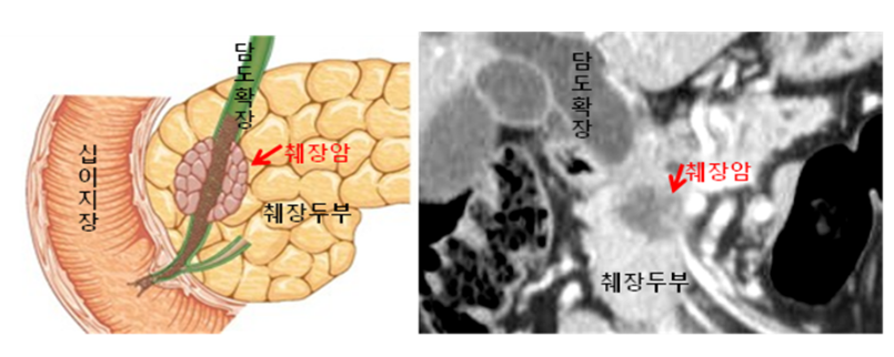 췌장암 초기 증상 및 검사 수술 방법 췌장암 2기 3기 4기 생존율 총정리 침묵의 살인자라 불리는 이유