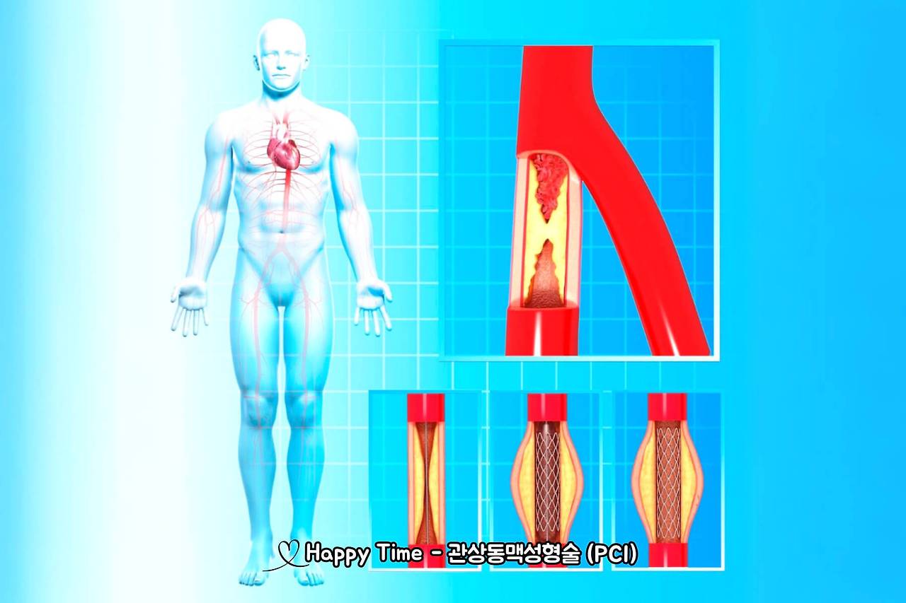 관상동맥성형술pci 종류와 시술과정에 대해 알아보자